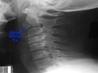Imaging of the Cervical Spine Injuries.ppt