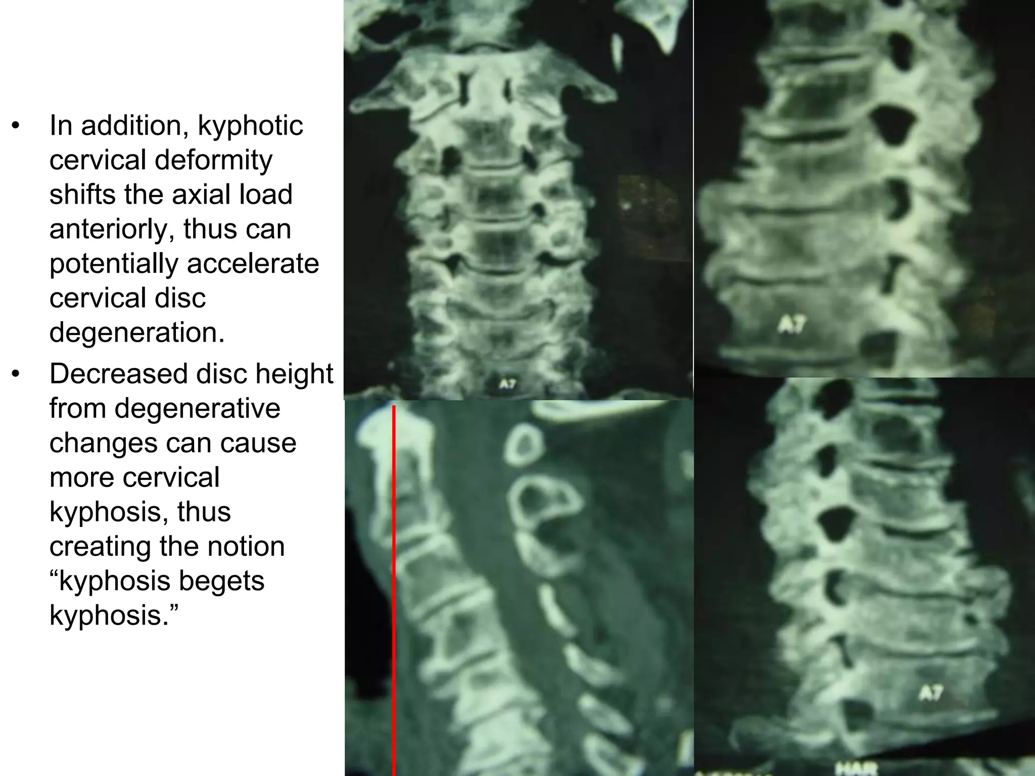 Cervical Spine Deformity 2019 | PPTX