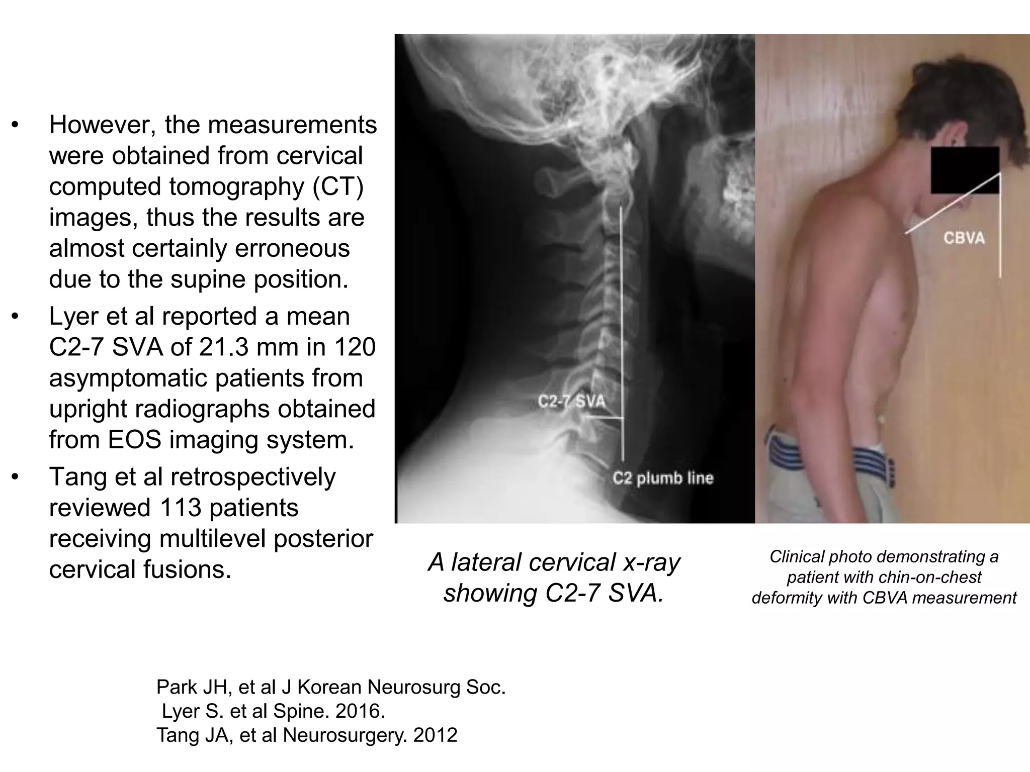 Cervical Spine Deformity 2019 | PPTX