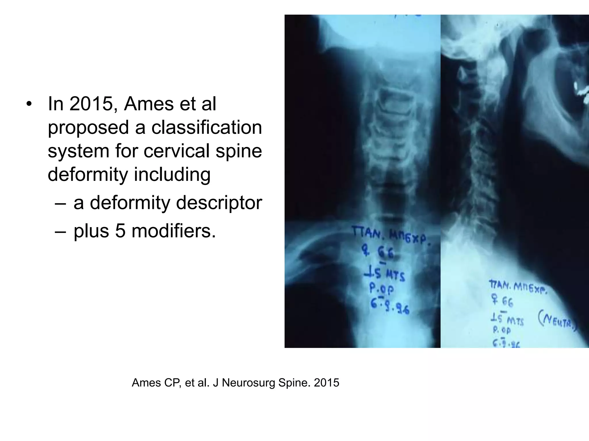 Cervical Spine Deformity 2019 | PPTX