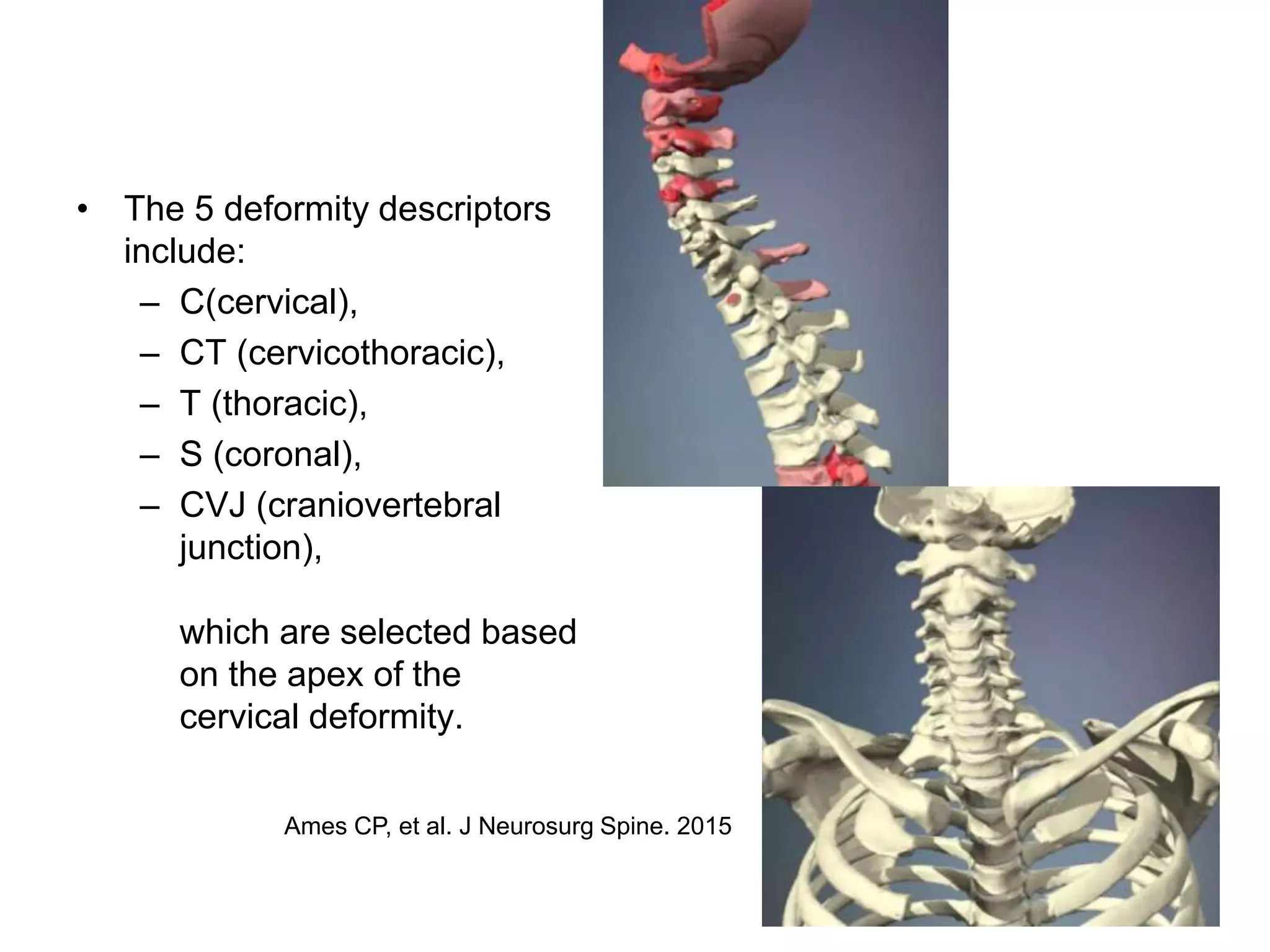 Cervical Spine Deformity 2019 | PPTX