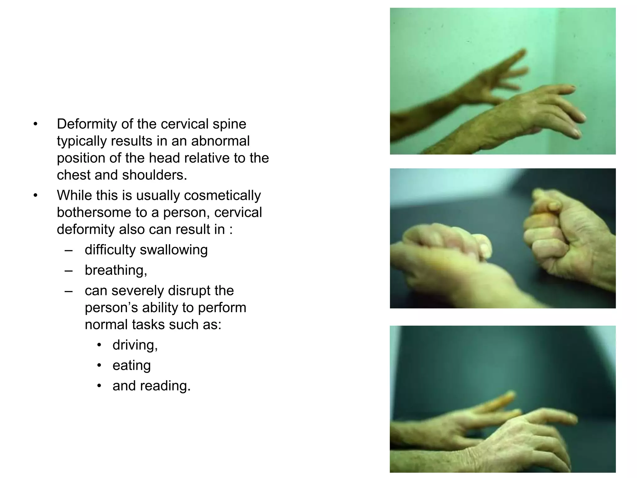 Cervical Spine Deformity 2019 | PPTX