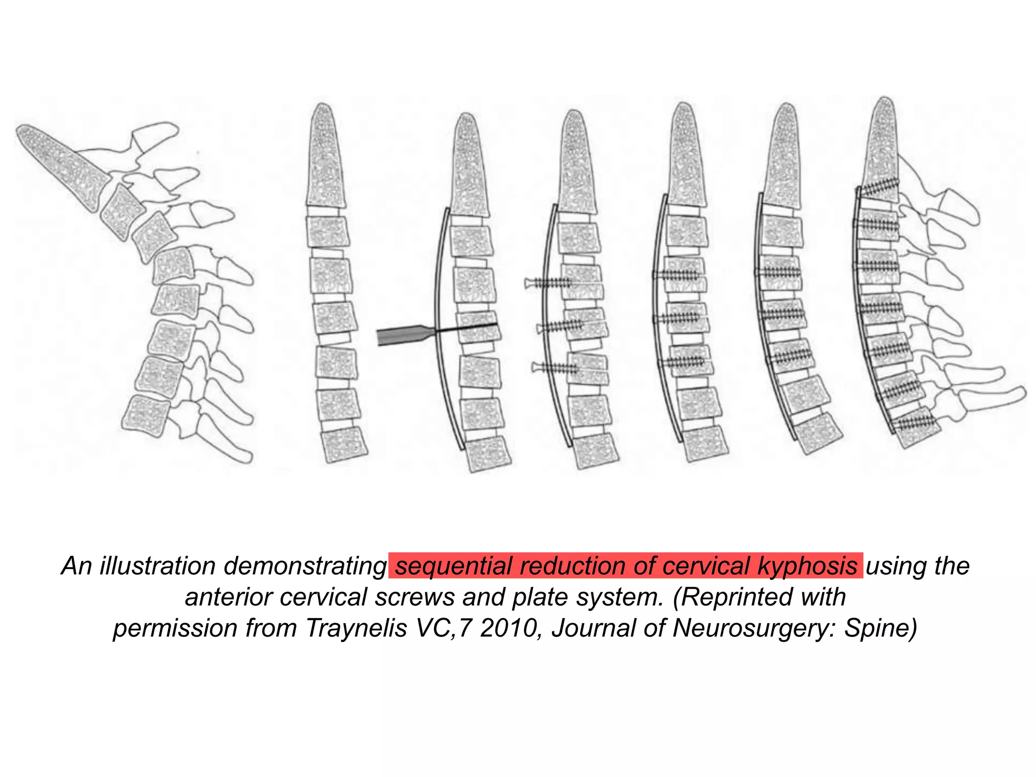 Cervical Spine Deformity 2019 | PPTX | Death, Injury, or Military ...
