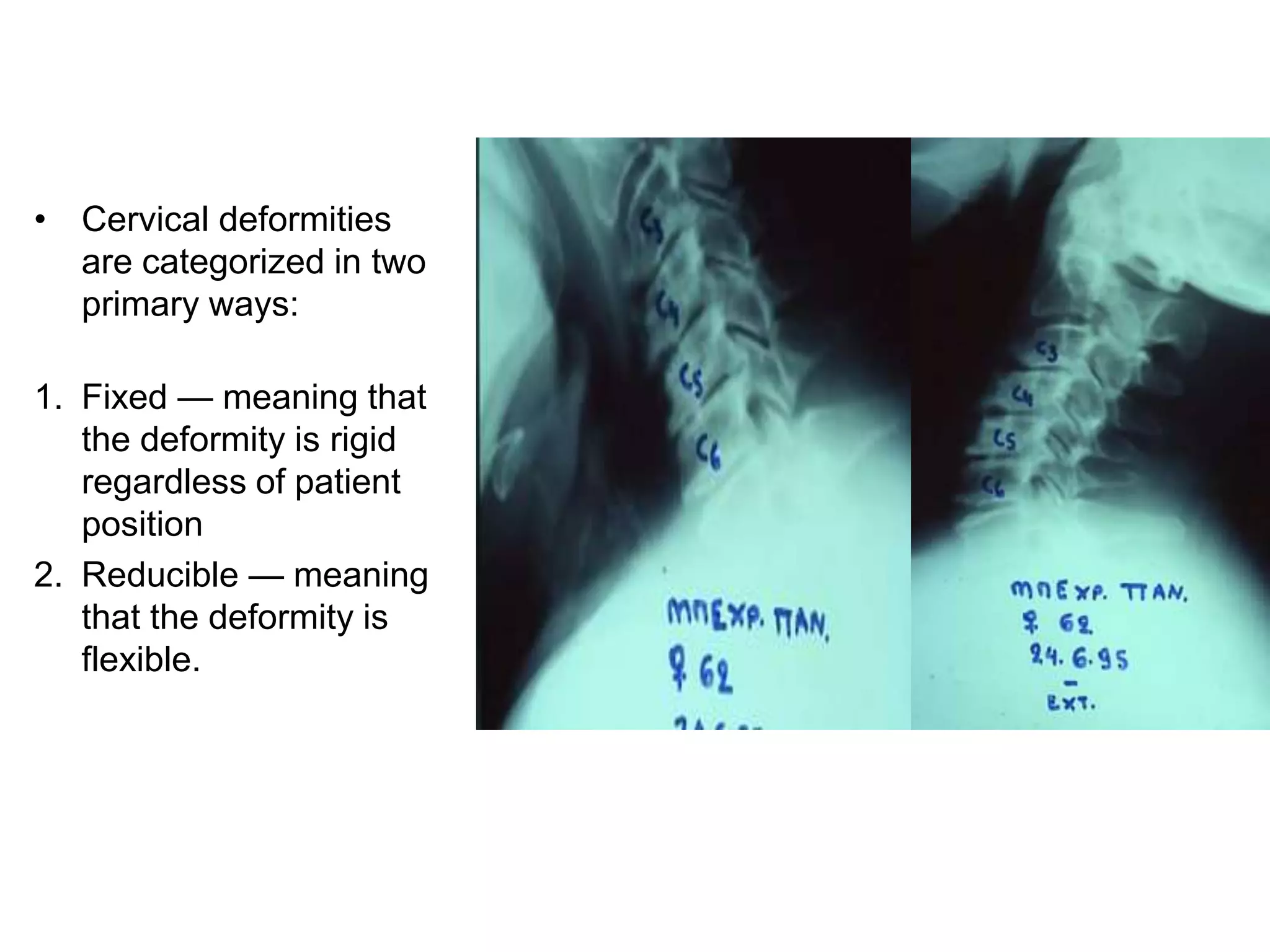 Cervical Spine Deformity 2019 | PPTX