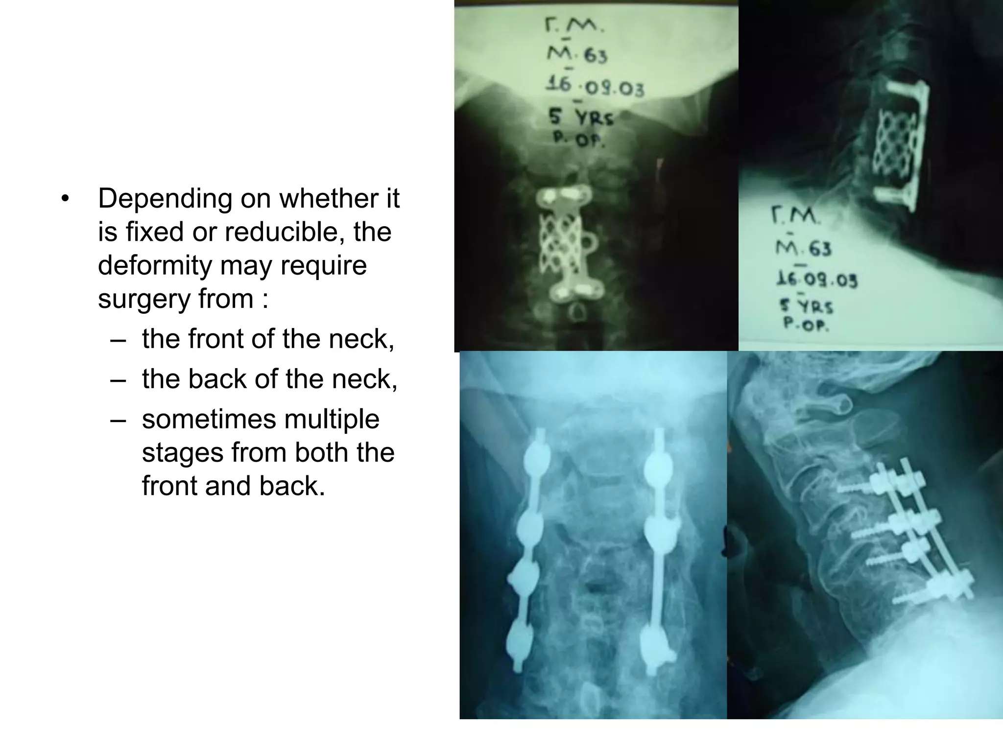 Cervical Spine Deformity 2019 | PPTX