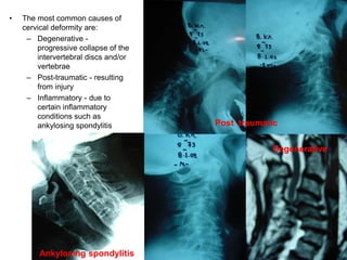 Cervical Spine Deformity 2019 | PPTX