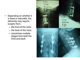 Cervical Spine Deformity 2019 | PPTX