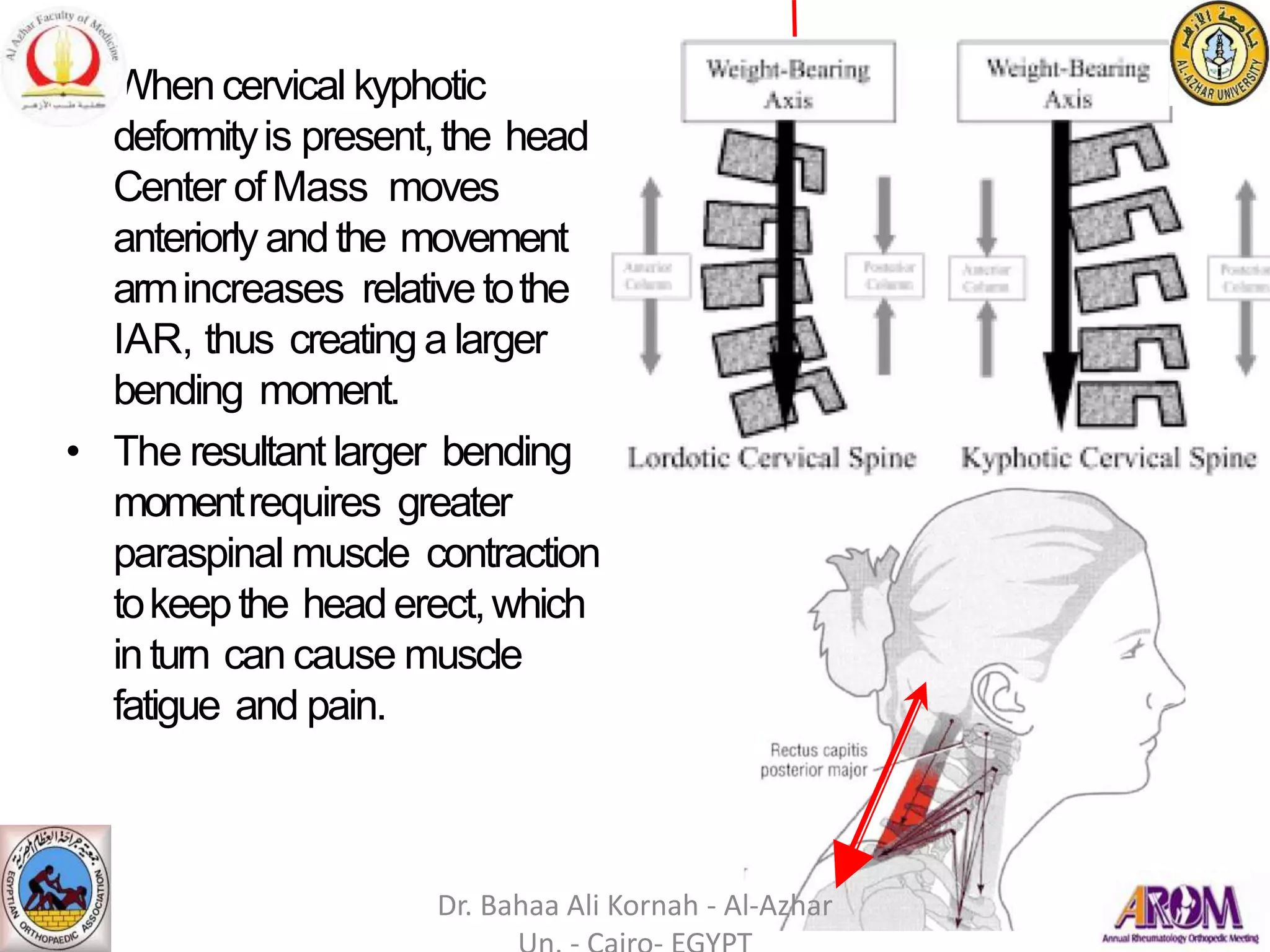 Cervical spine deformity bahaa | PPT