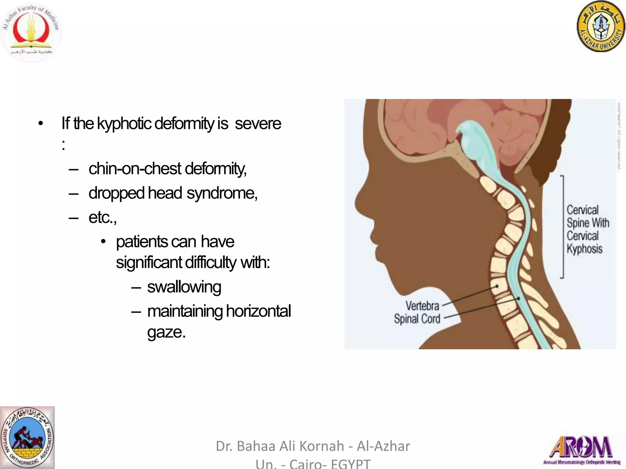 Cervical spine deformity bahaa | PPT