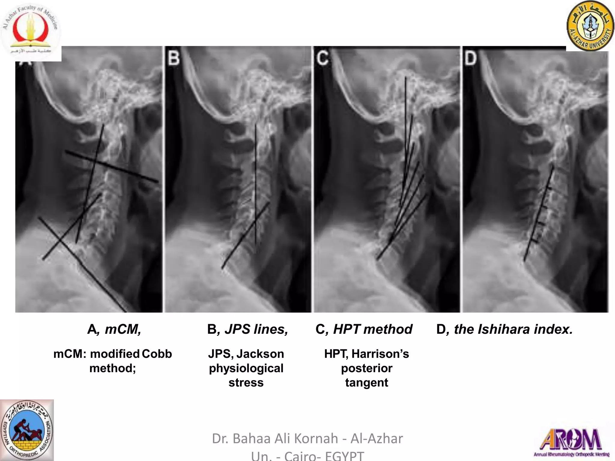 Cervical spine deformity bahaa | PPT