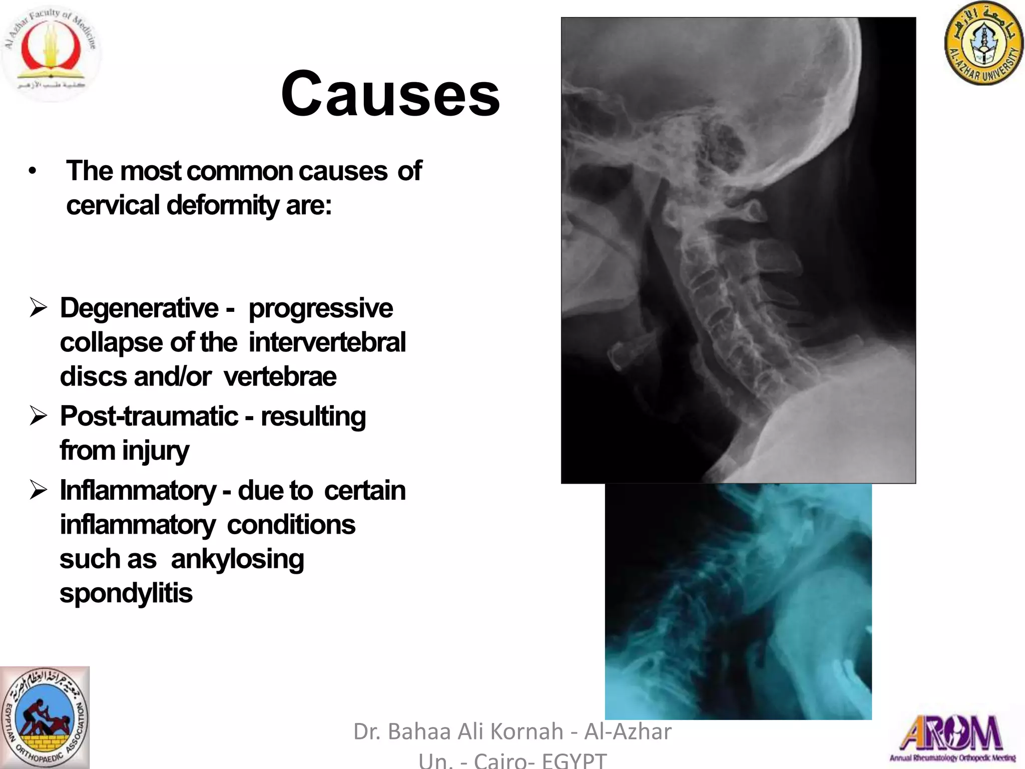 Cervical spine deformity bahaa | PPT