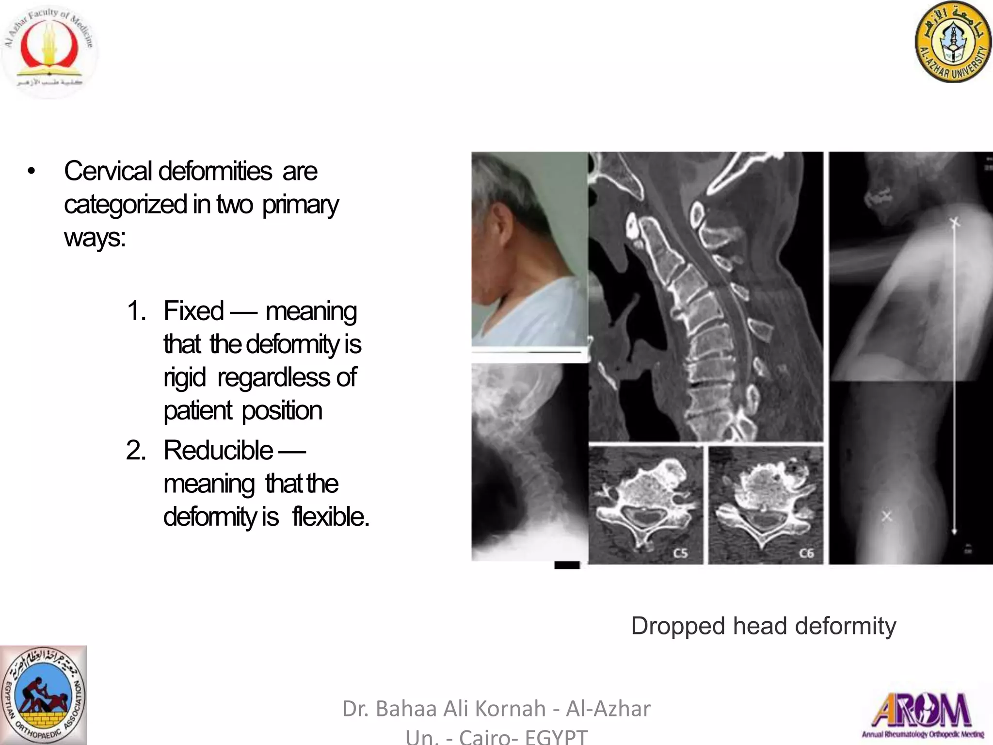 Cervical spine deformity bahaa | PPT