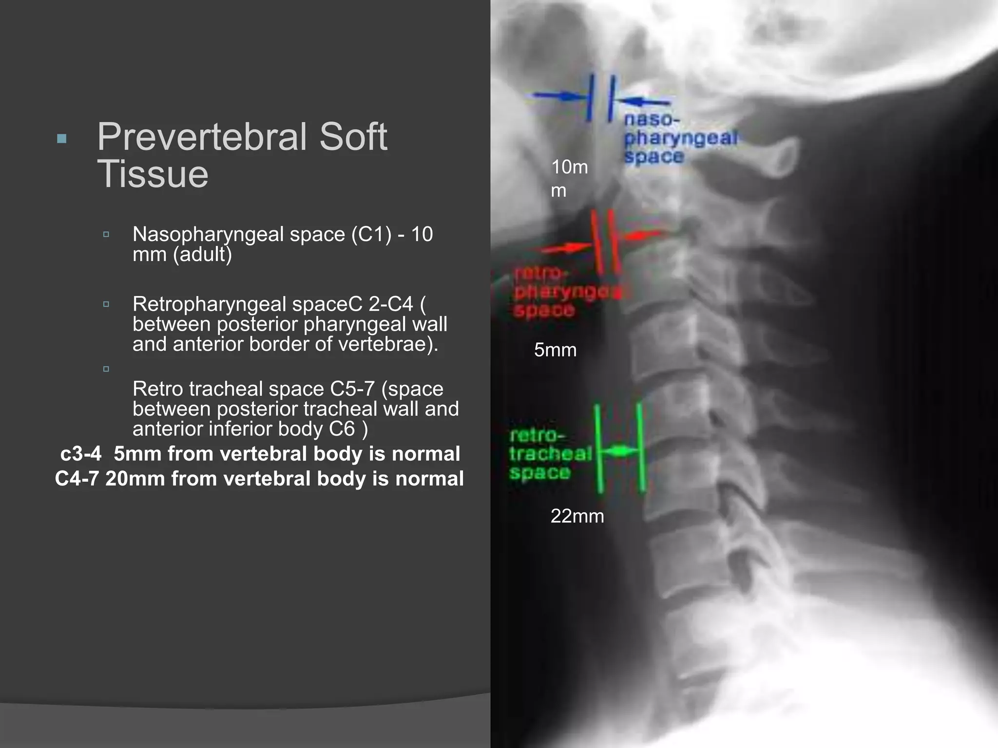 Cervical spine fractures muhamma | PPTX | Death, Injury, or Military ...