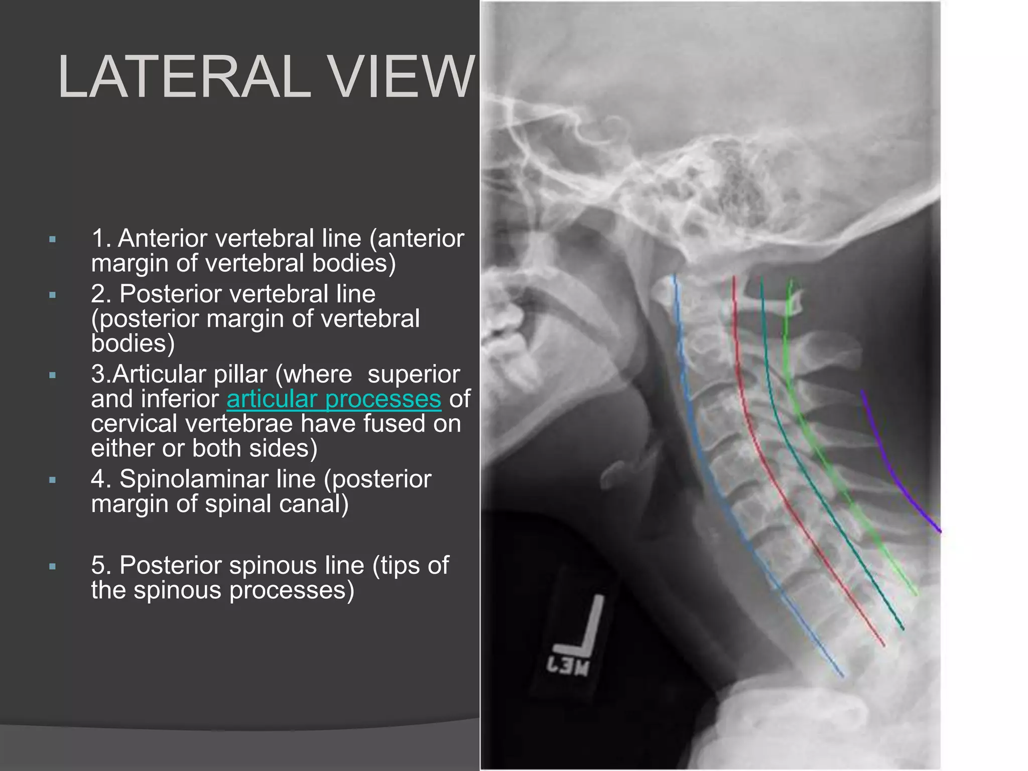 Cervical spine fractures muhamma | PPTX