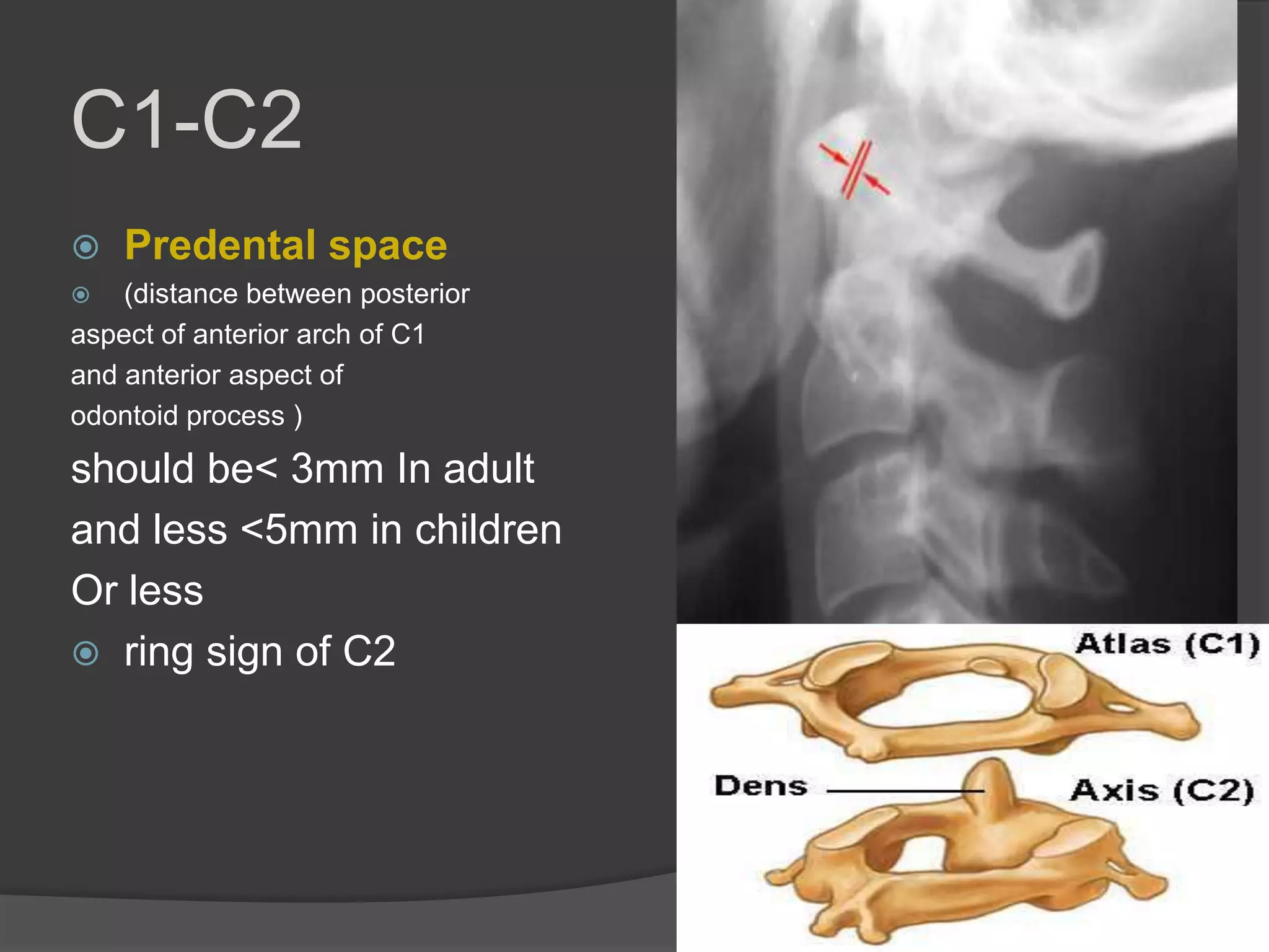 Cervical spine fractures muhamma | PPTX