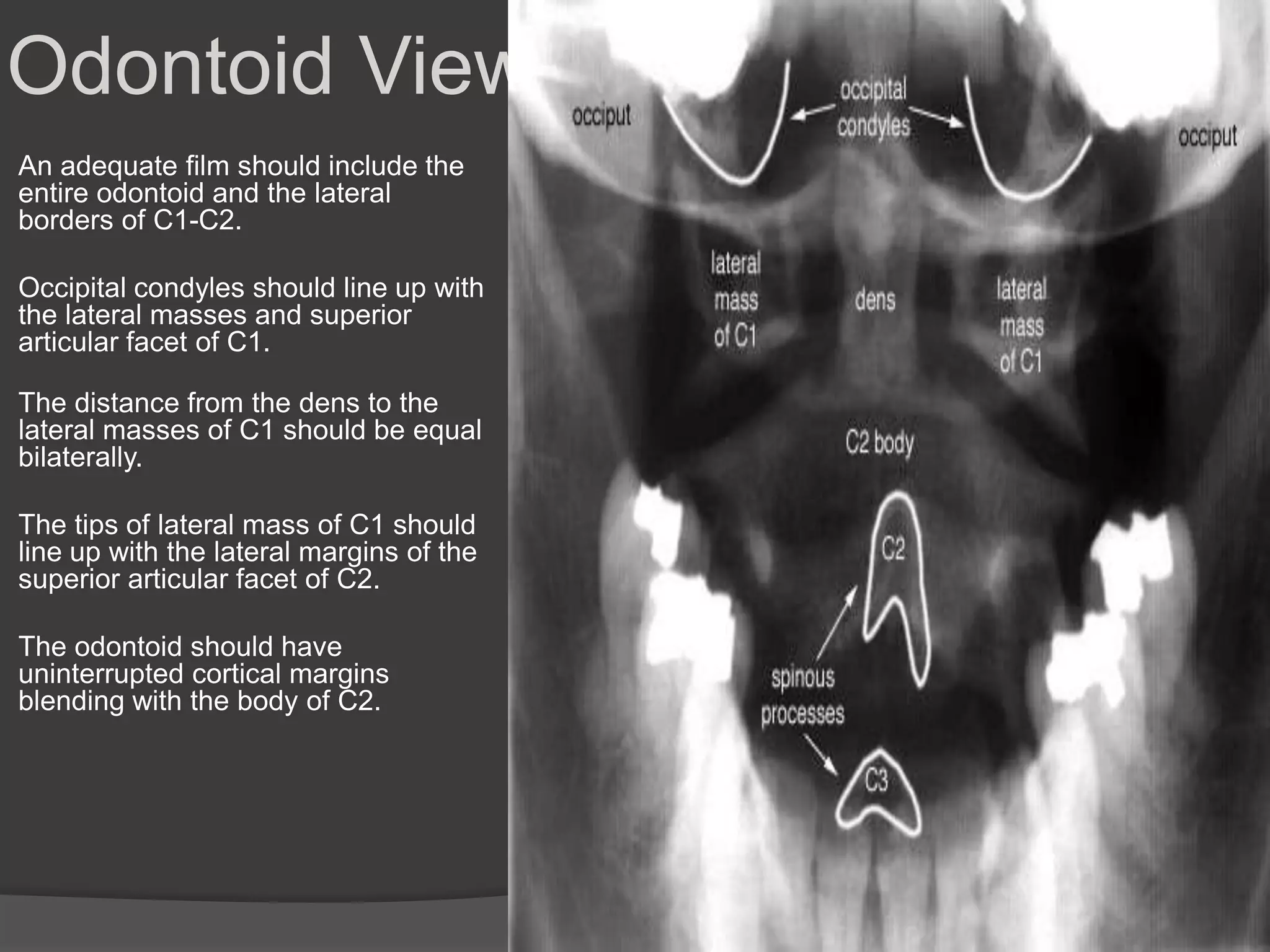 Cervical spine fractures muhamma | PPTX