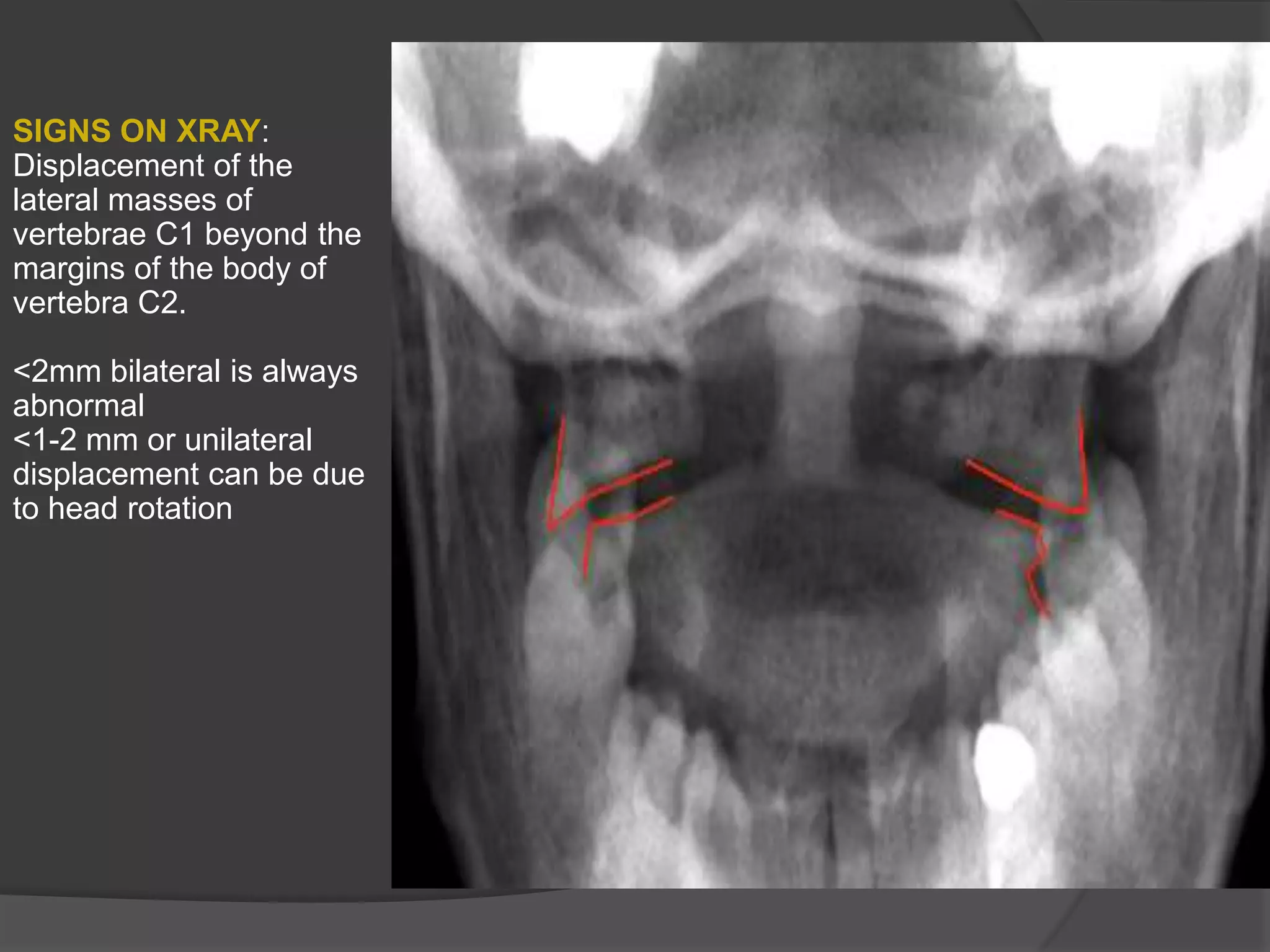 Cervical spine fractures muhamma | PPTX