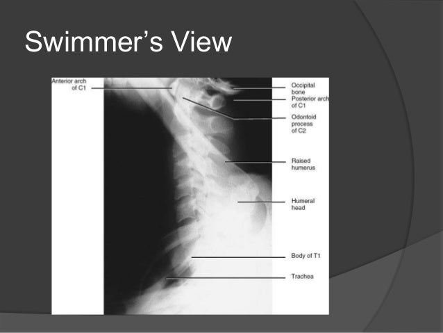 Cervical spine fractures muhamma