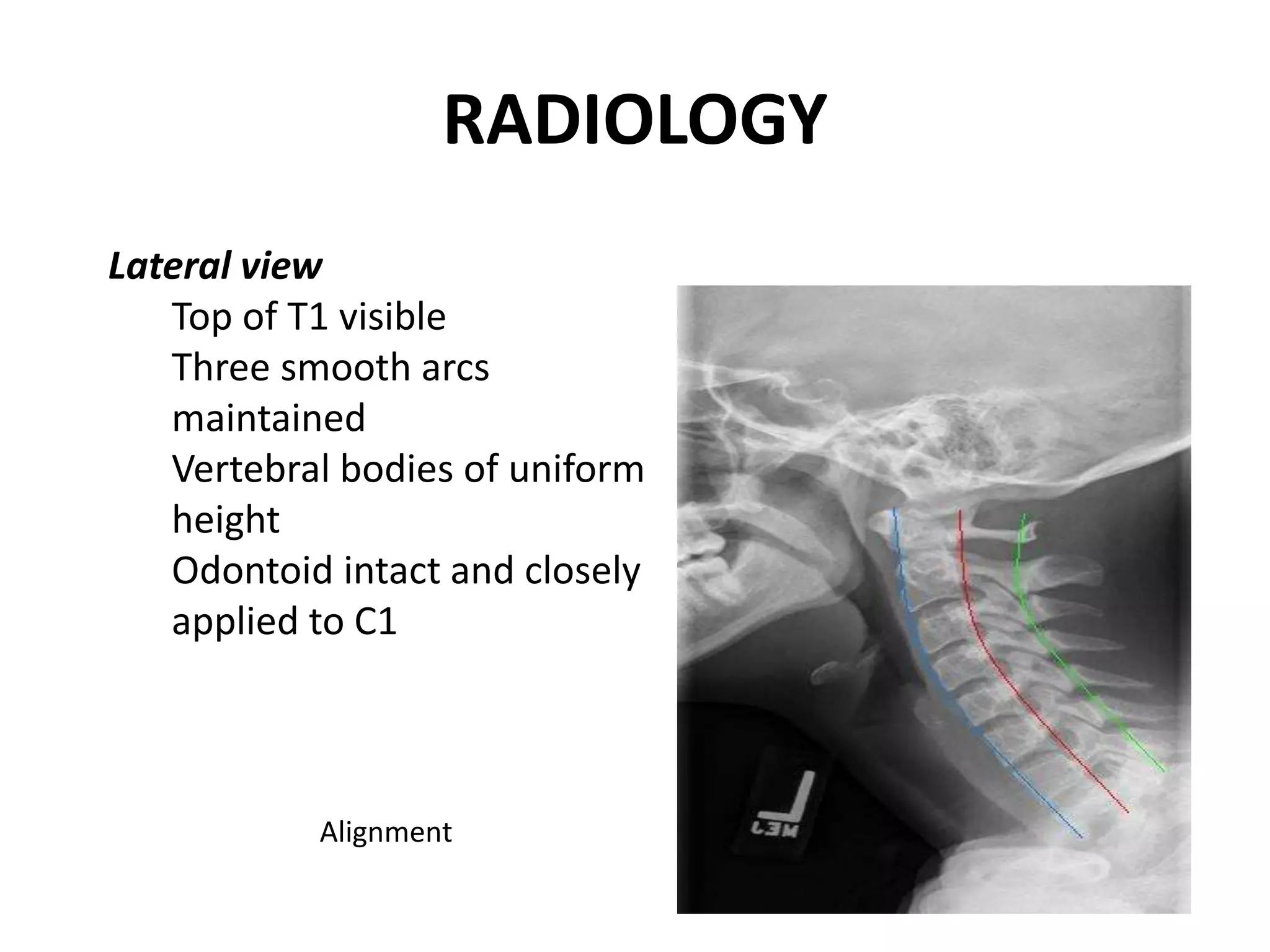 Cervical spine injuries and its management | PPTX