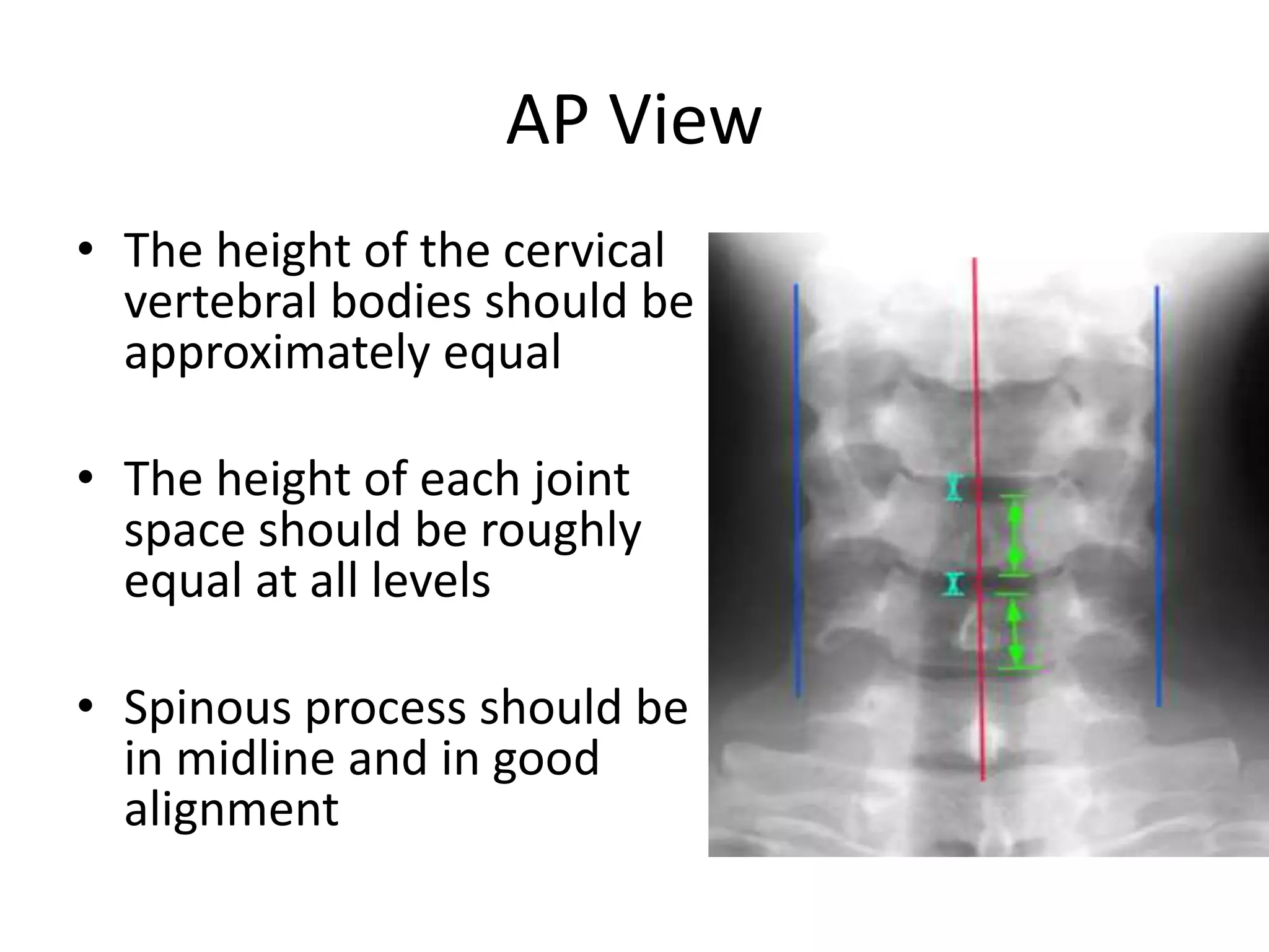 Cervical spine injuries and its management | PPTX