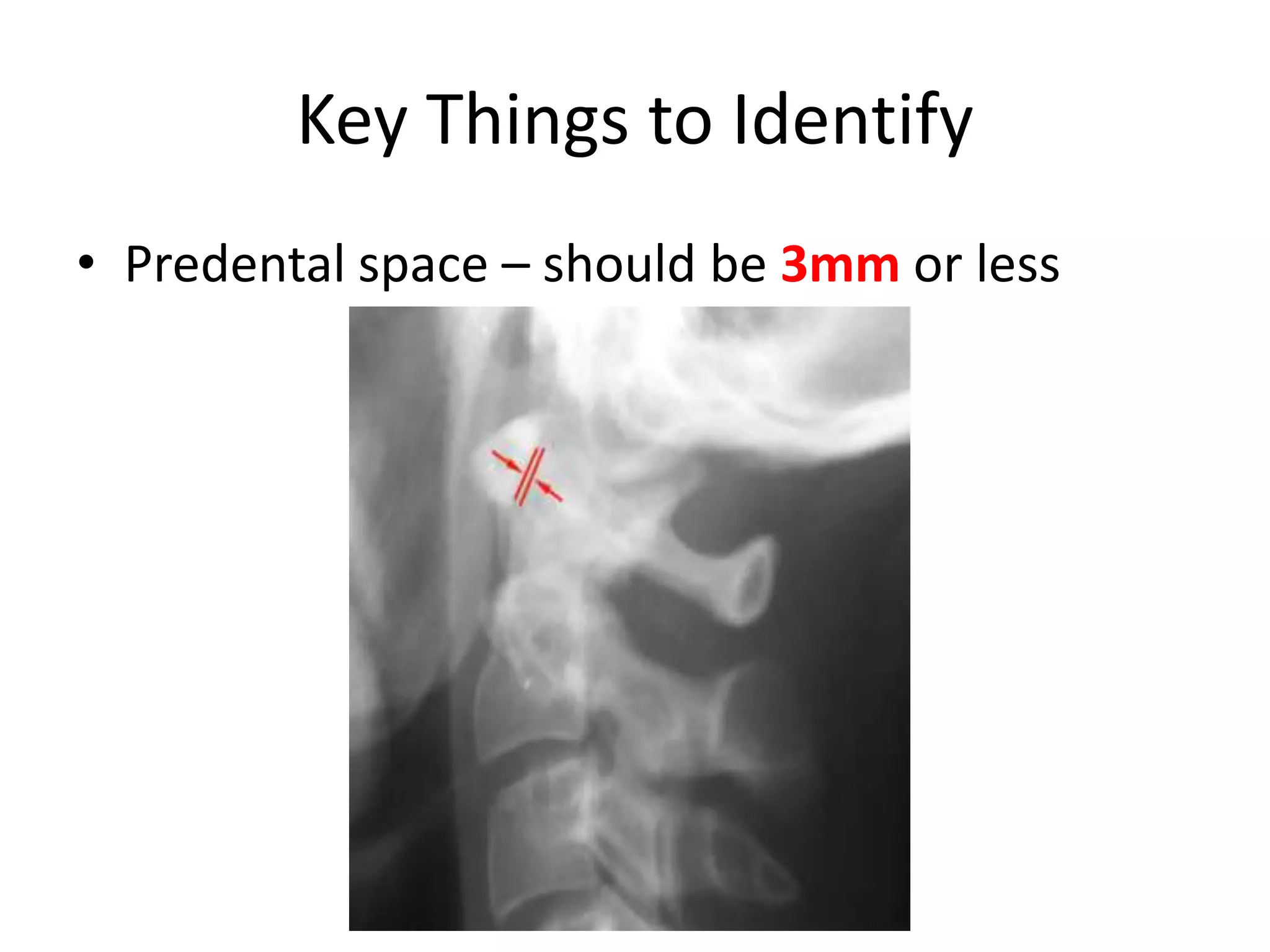 Cervical spine injuries and its management | PPTX