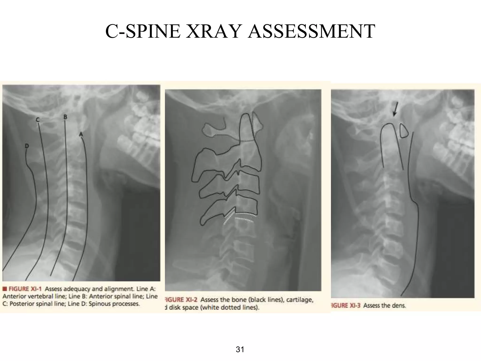 Cervical spine injury | PPTX