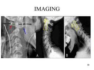 Cervical spine injury | PPTX