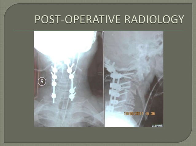 Cervical spinepathology | PPT