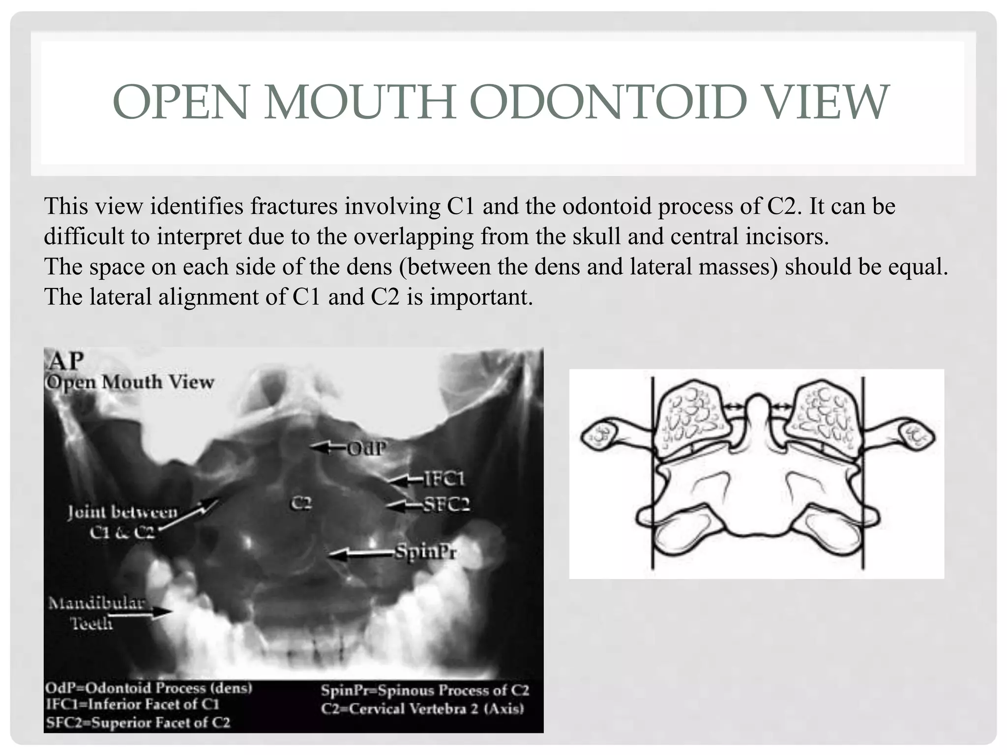 Cervical Spine Radiograph - MaxilloFacial Trauma | PPTX