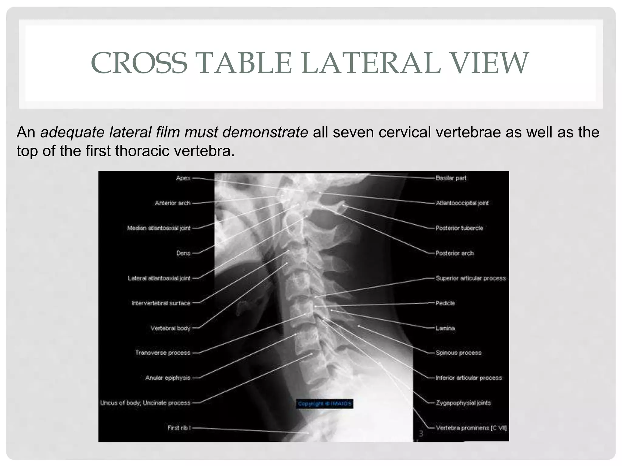 Cervical Spine Radiograph - MaxilloFacial Trauma | PPTX