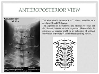 Cervical Spine Radiograph - MaxilloFacial Trauma | PPT
