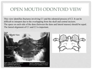 Cervical Spine Radiograph - MaxilloFacial Trauma | PPT
