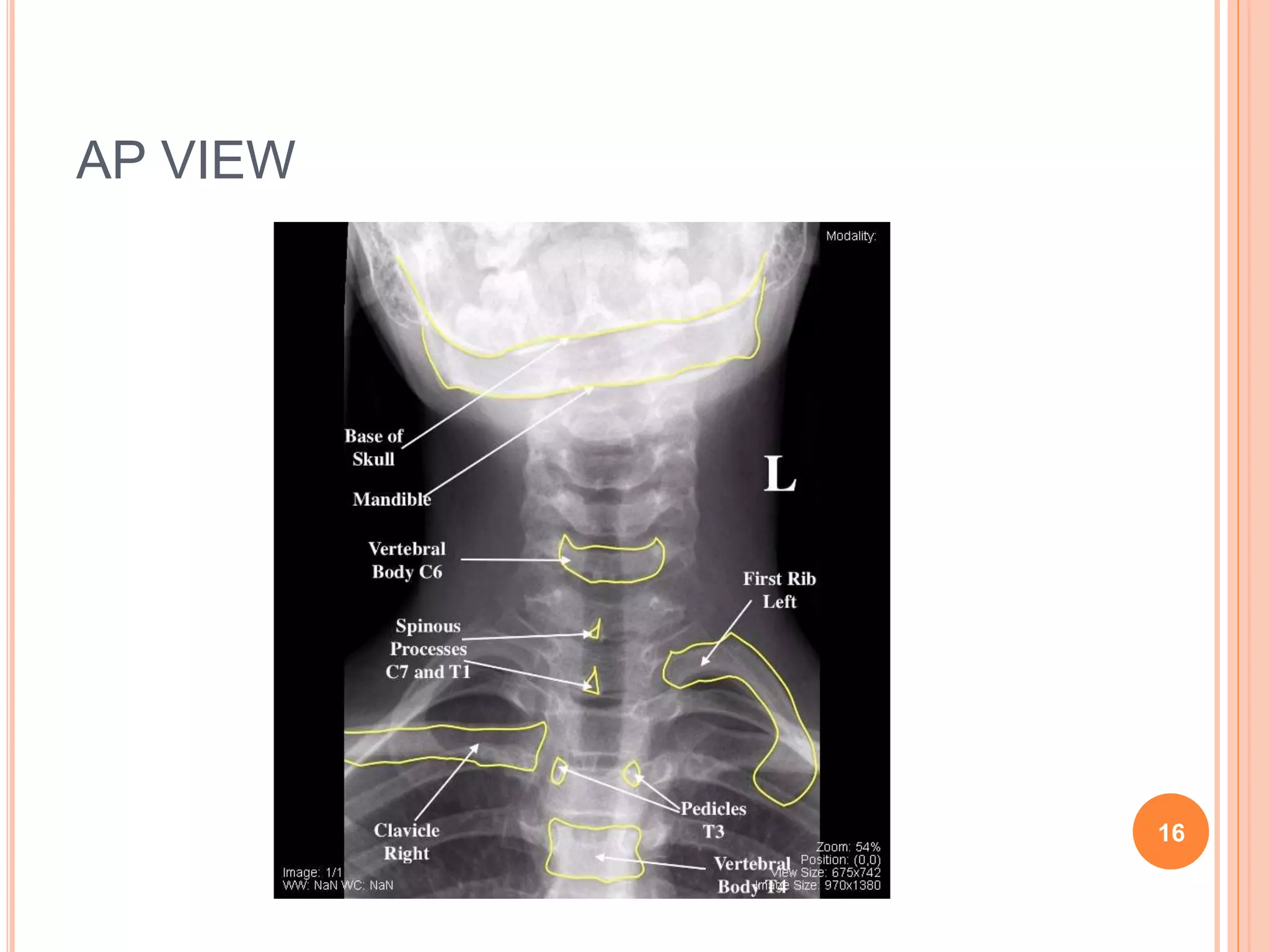 Cervical spine fracture radiology, classification and management | PPTX