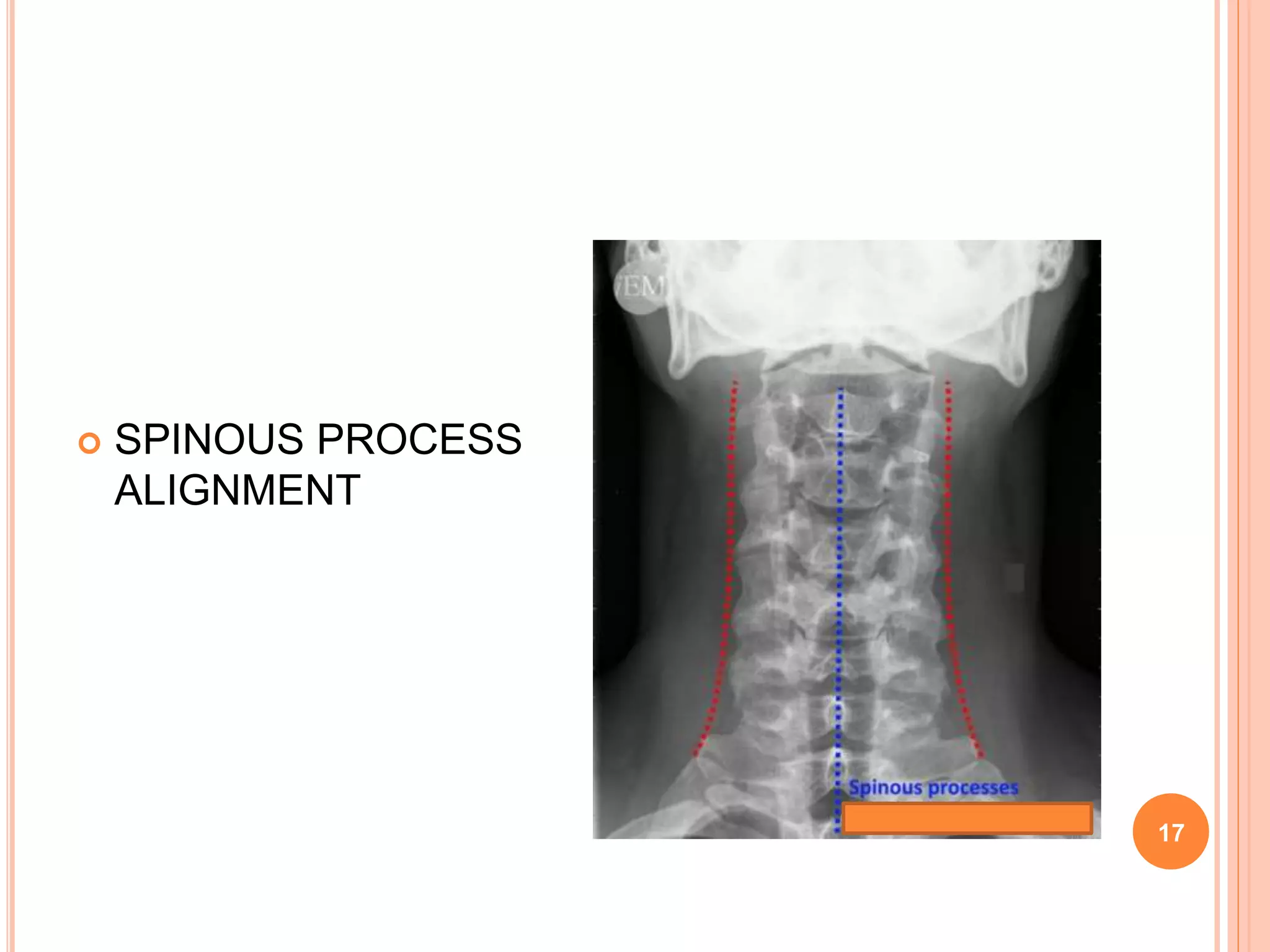 Cervical spine fracture radiology, classification and management | PPTX