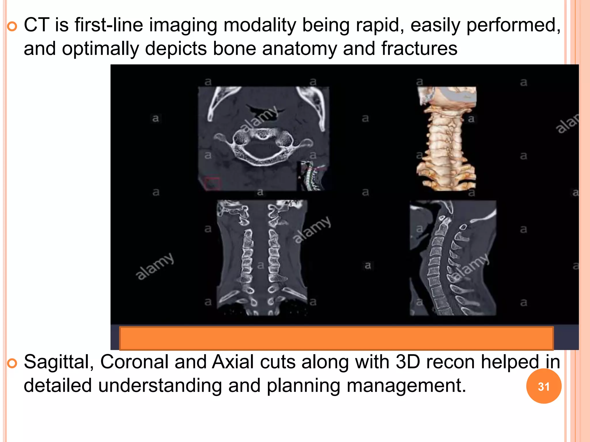 Cervical spine fracture radiology, classification and management | PPTX