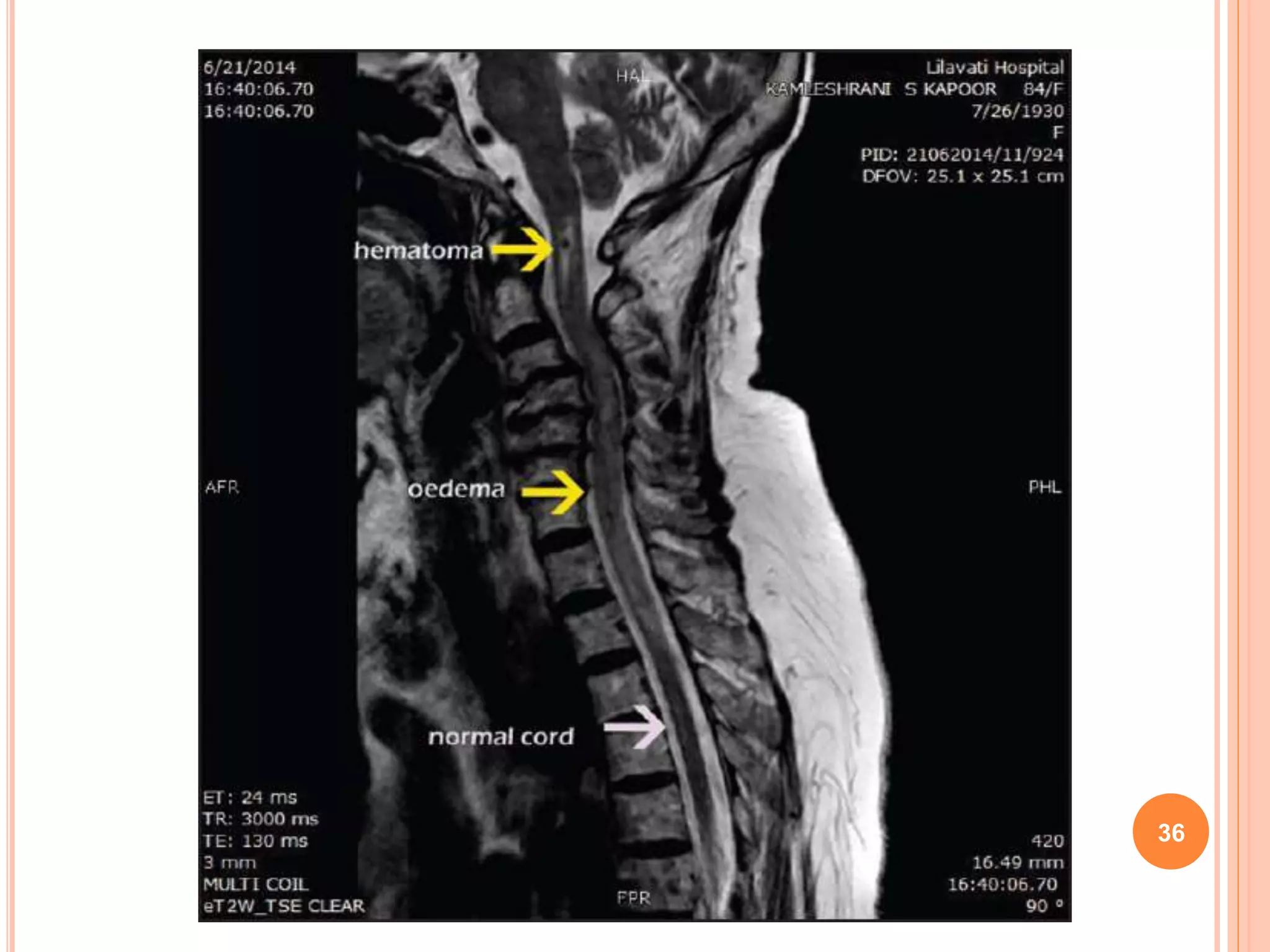 Cervical spine fracture radiology, classification and management | PPTX