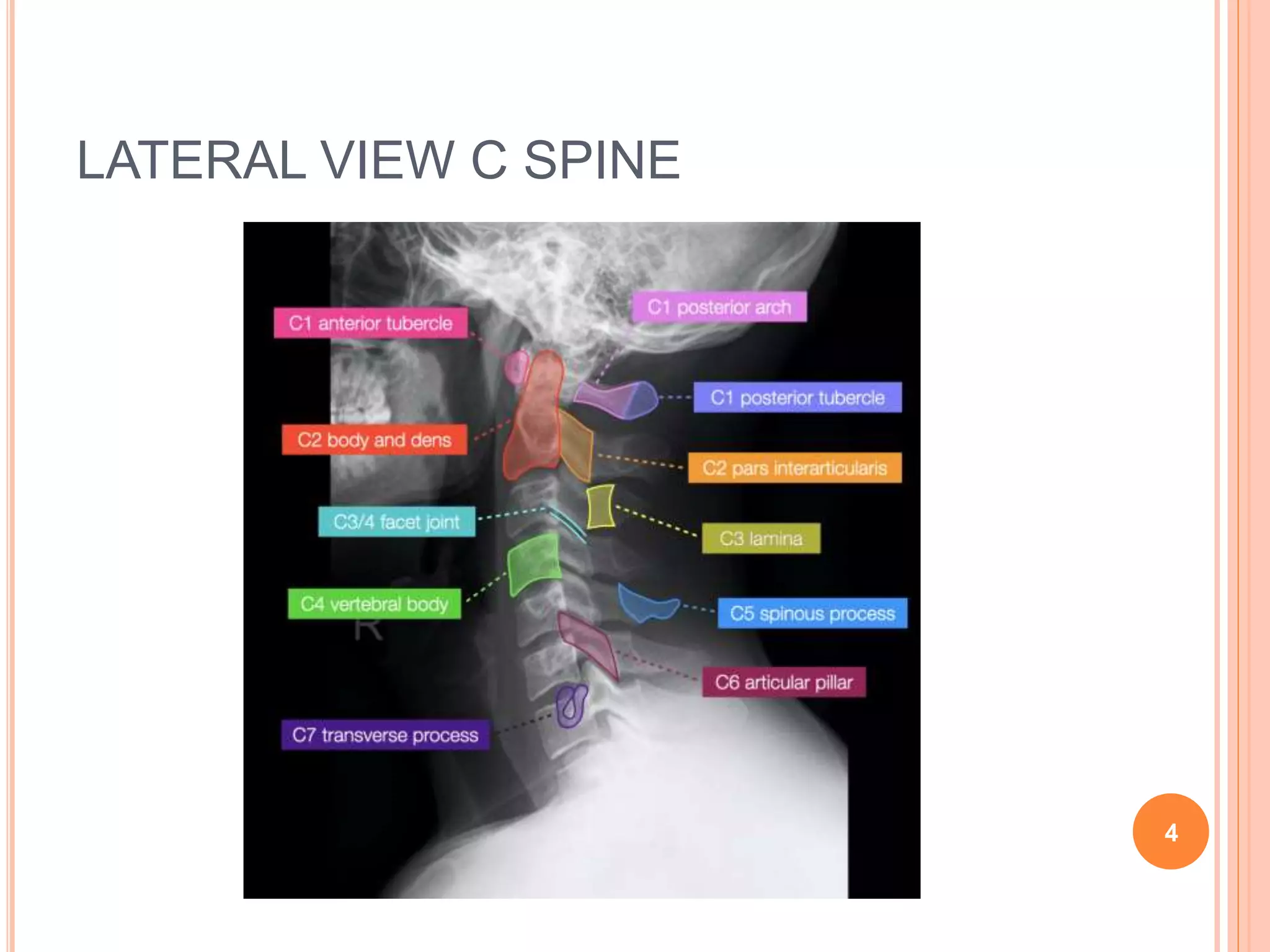 Cervical spine fracture radiology, classification and management | PPTX