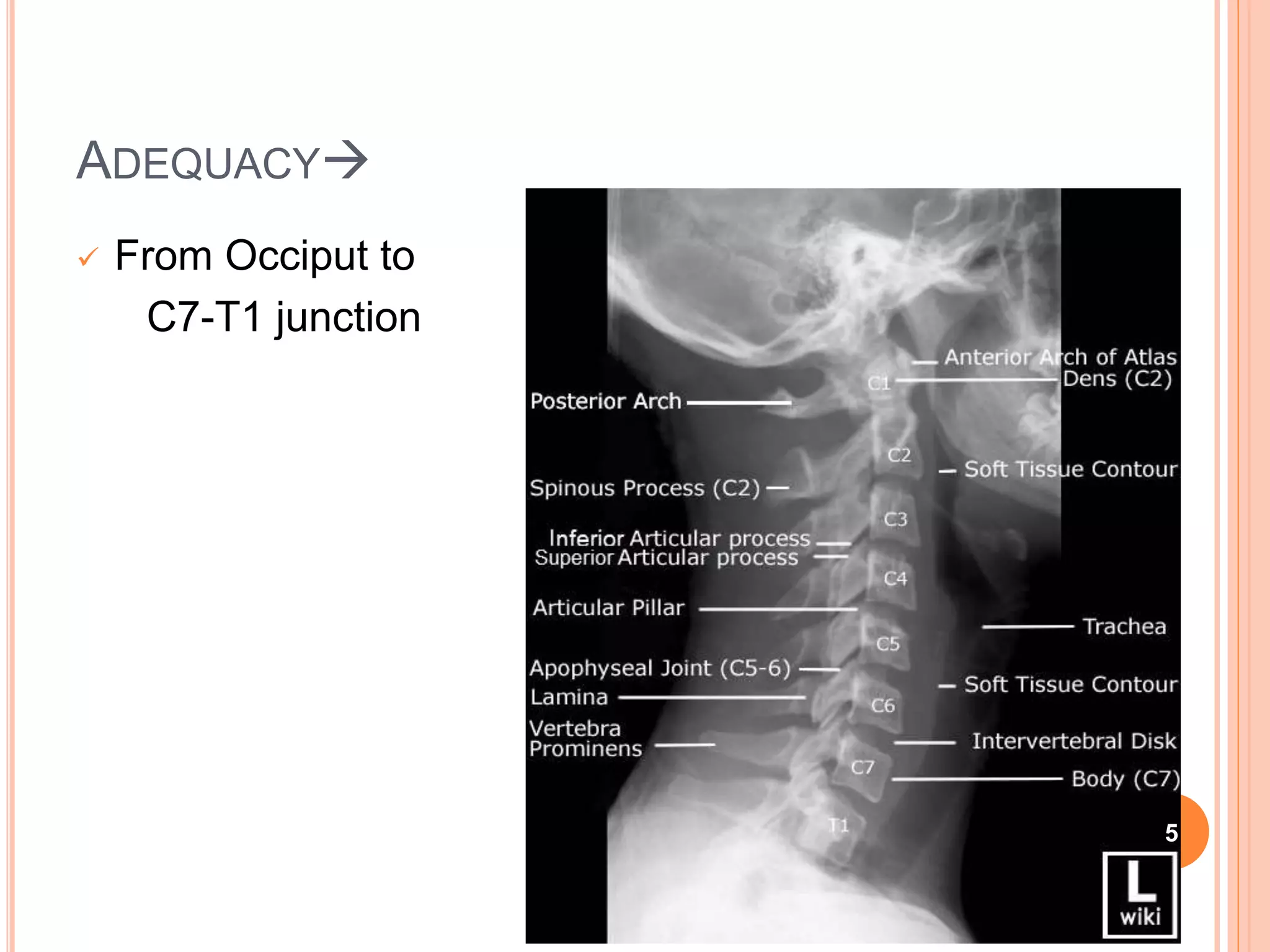Cervical spine fracture radiology, classification and management | PPTX
