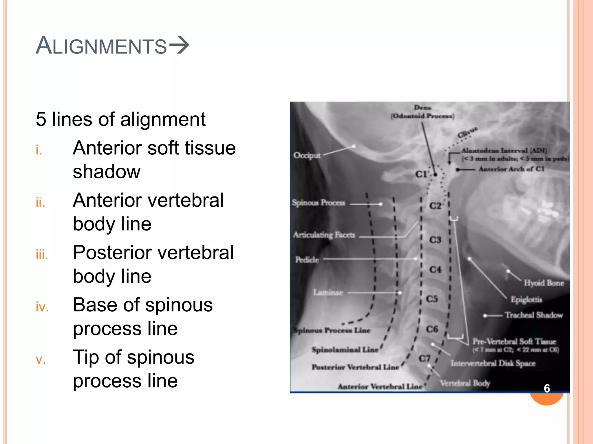Cervical spine fracture radiology, classification and management | PPTX