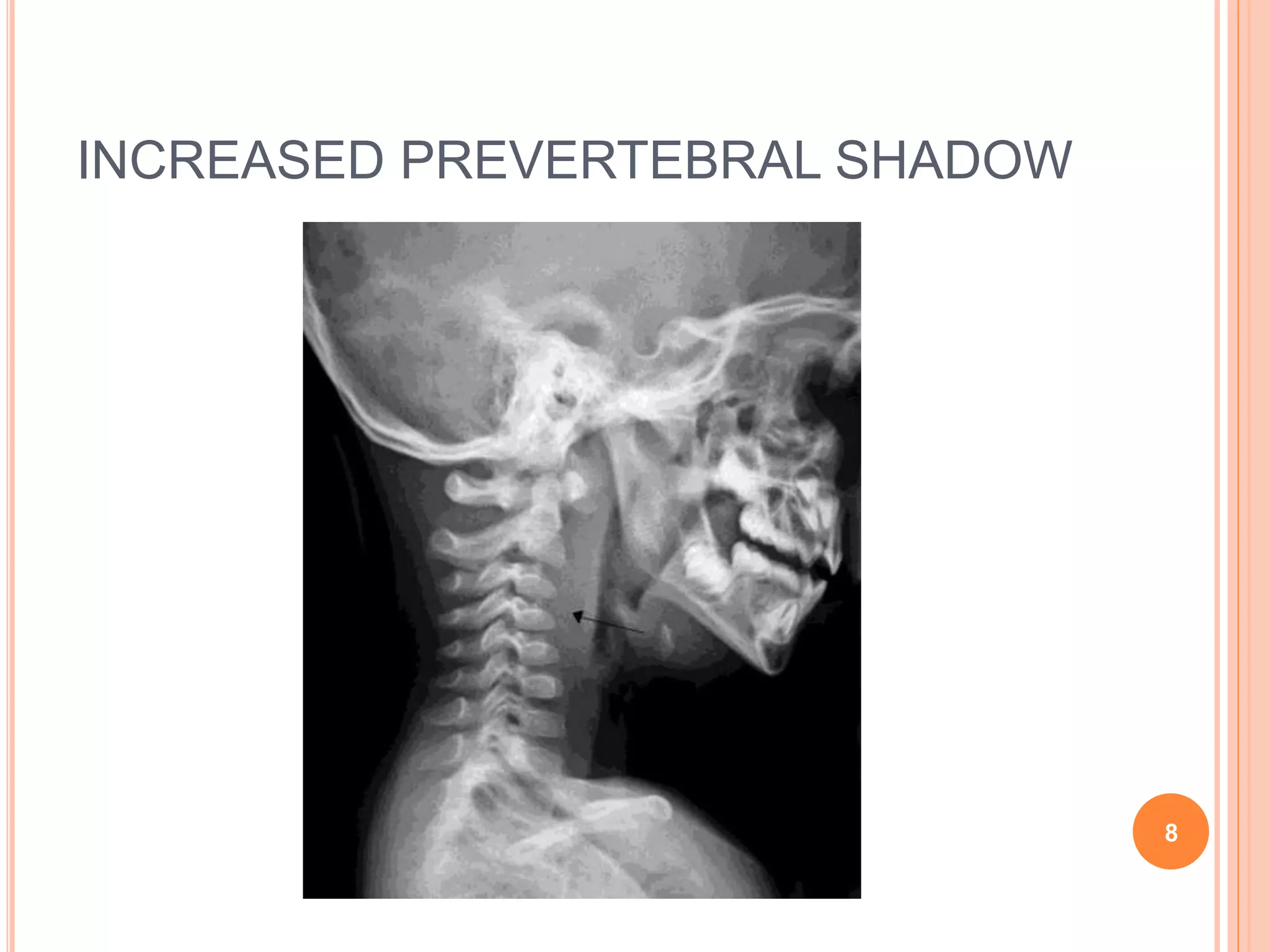 Cervical spine fracture radiology, classification and management | PPTX