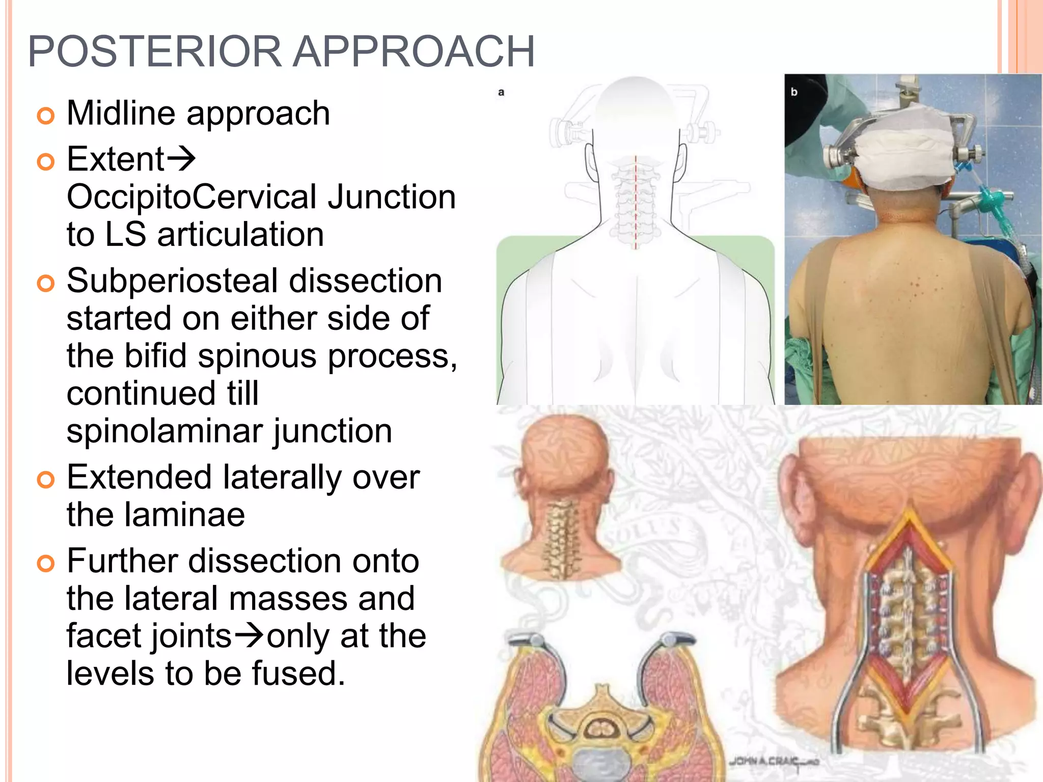 Cervical spine fracture radiology, classification and management | PPTX