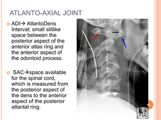 Cervical spine fracture radiology, classification and management | PPTX