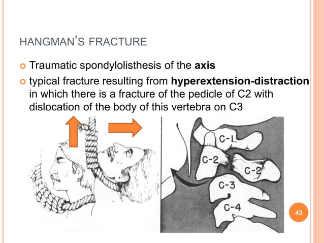 Cervical spine fracture radiology, classification and management | PPTX ...