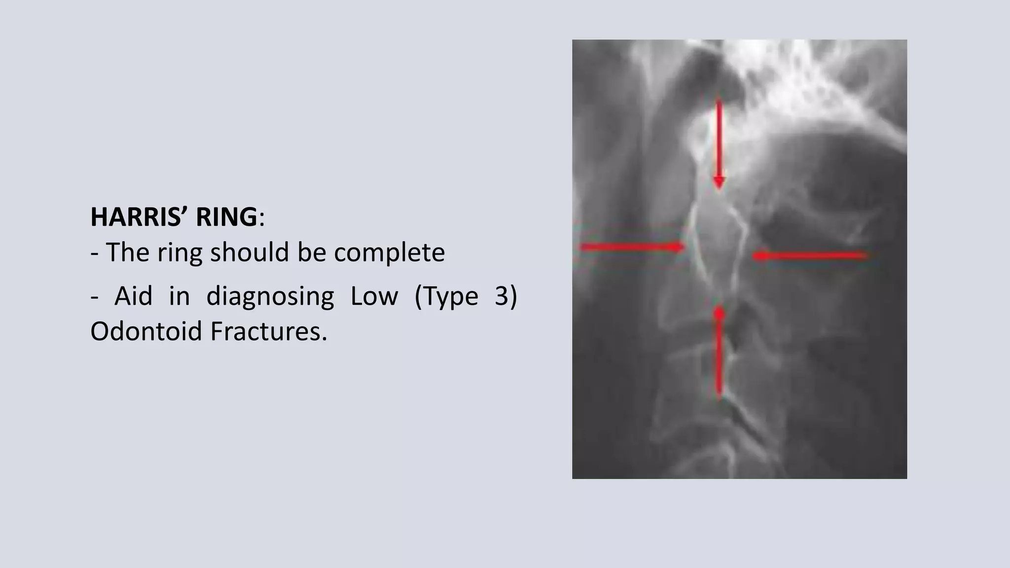 Cervical spine trauma | PPTX
