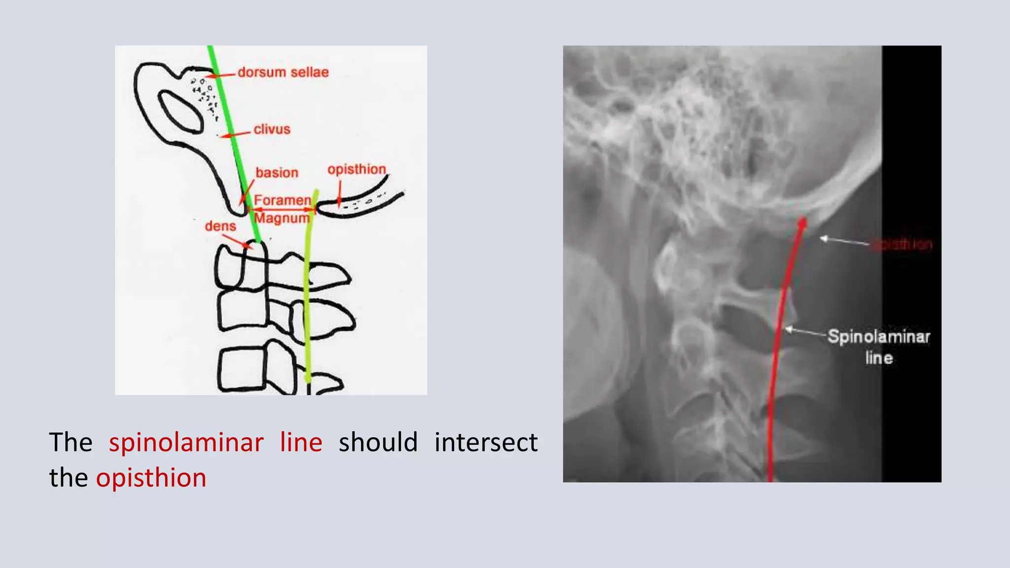 Cervical spine trauma | PPTX