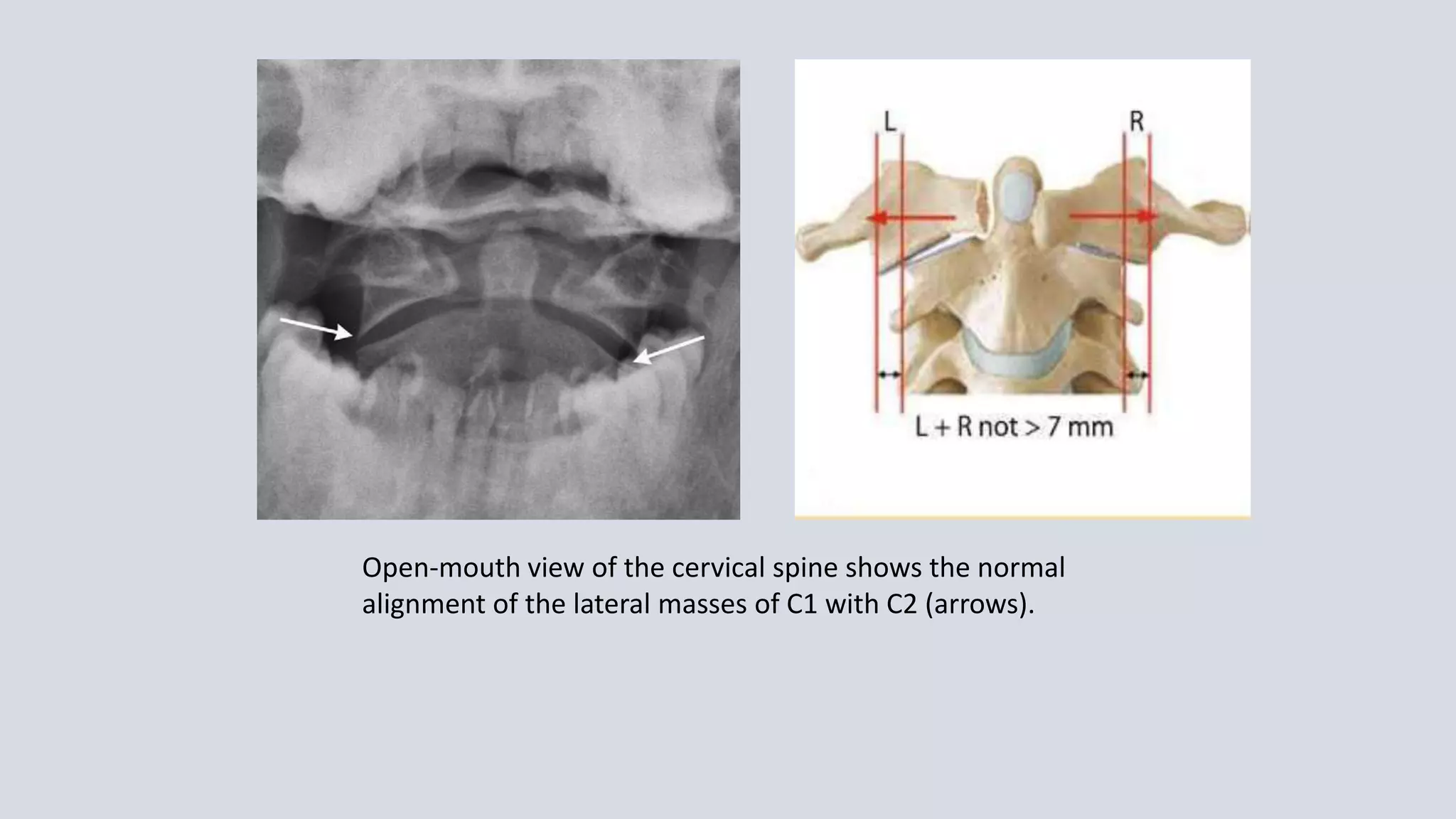 Cervical spine trauma | PPTX