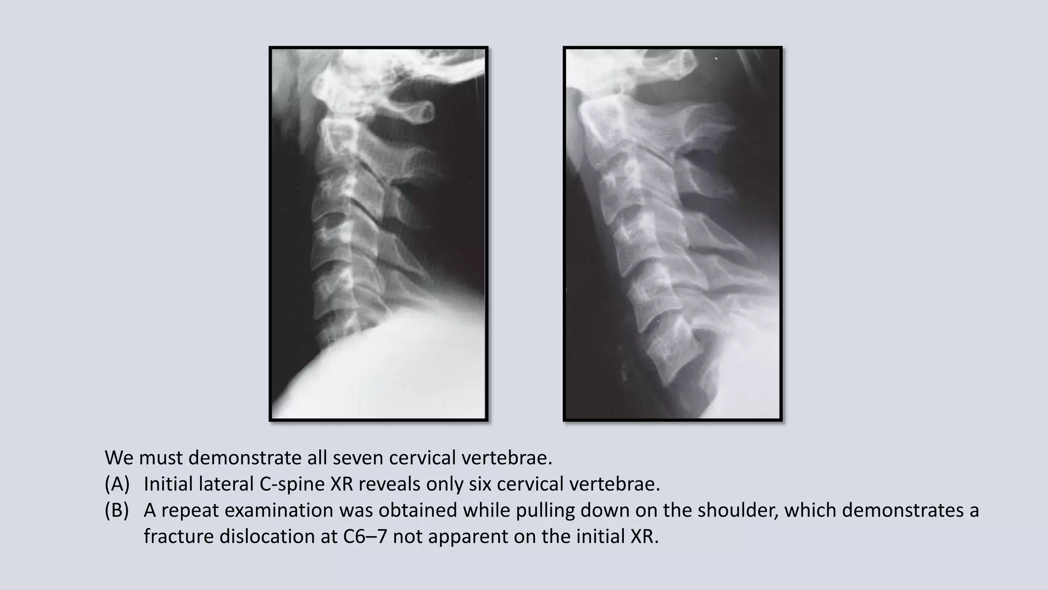 Cervical spine trauma | PPTX