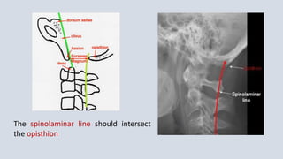 Cervical spine trauma | PPTX