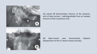 Cervical spine trauma | PPTX