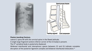 Cervical spine trauma | PPTX